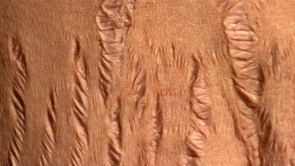 Vergetures : Causes, Prévention et Traitements - MYSA